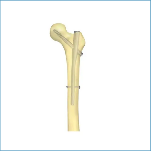 Intramedullary Nails – IMC Supplier