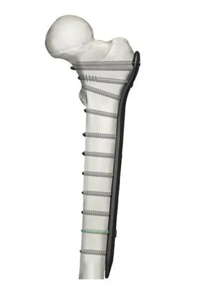 Multi-Axial Proximal Femur Locking Plate – IMC Supplier