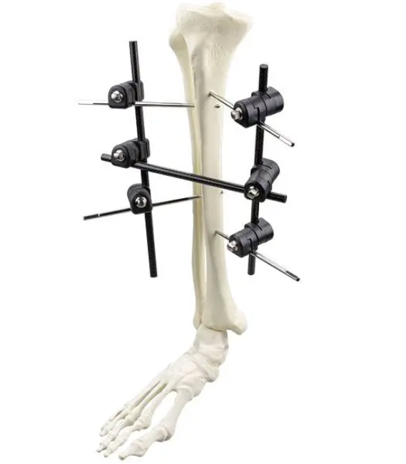 Φ8.0 Series External Fixation Fixator – Tibia Frame – IMC Supplier