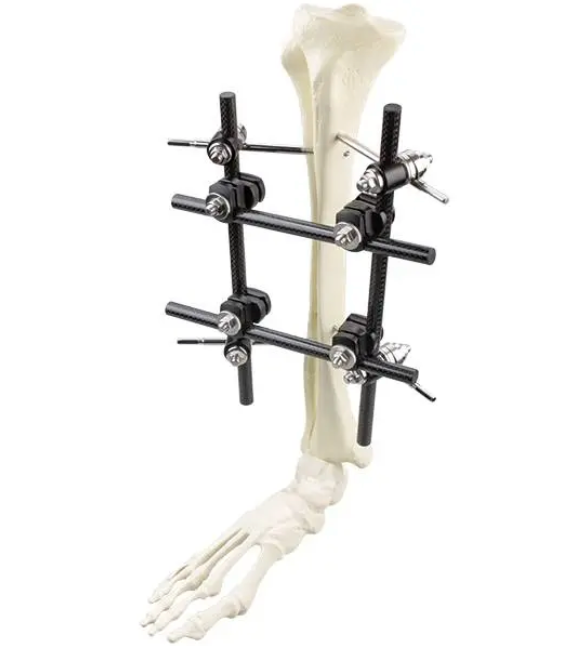 Φ11.0 Series External Fixation Fixator – Tibia Backbone Frame – IMC ...