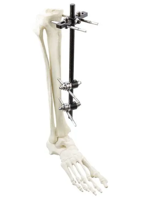 Φ11.0 Series External Fixation Fixator – Tibia Plateau Frame – IMC Supplier
