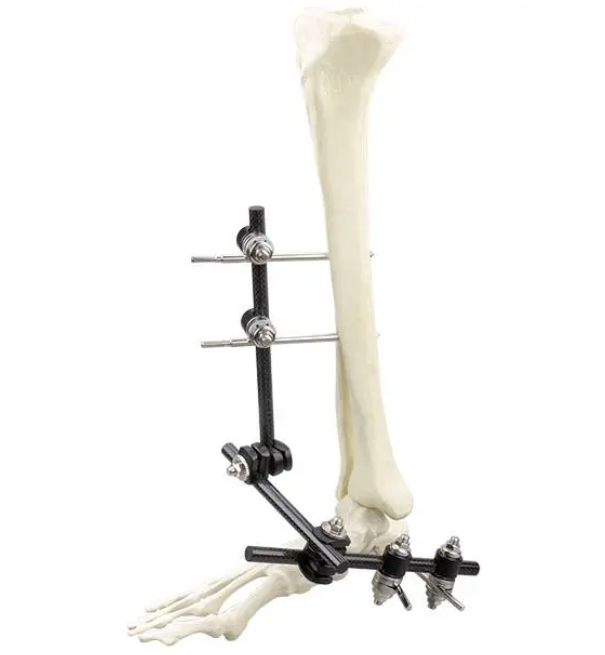Φ11.0 Series External Fixation Fixator – Ankle Bridge Frame – IMC Supplier